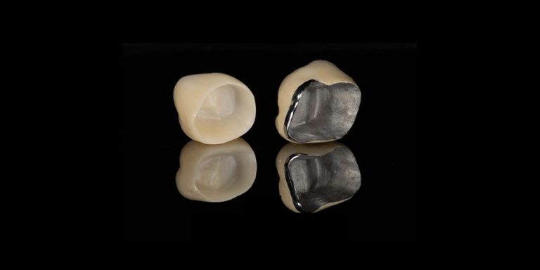 Ceramo-metal - OT IMPLANT LAB